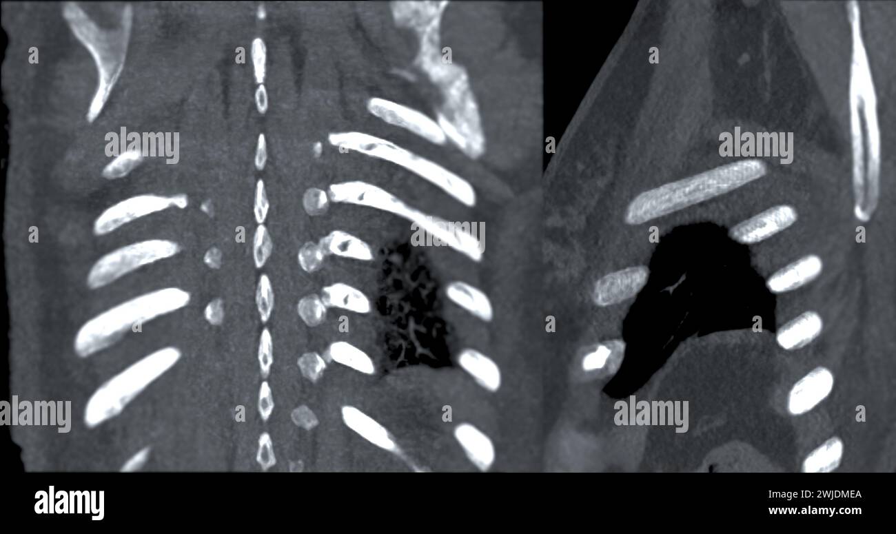 A CTA pulmonary artery reveals a detailed view of the lung blood ...