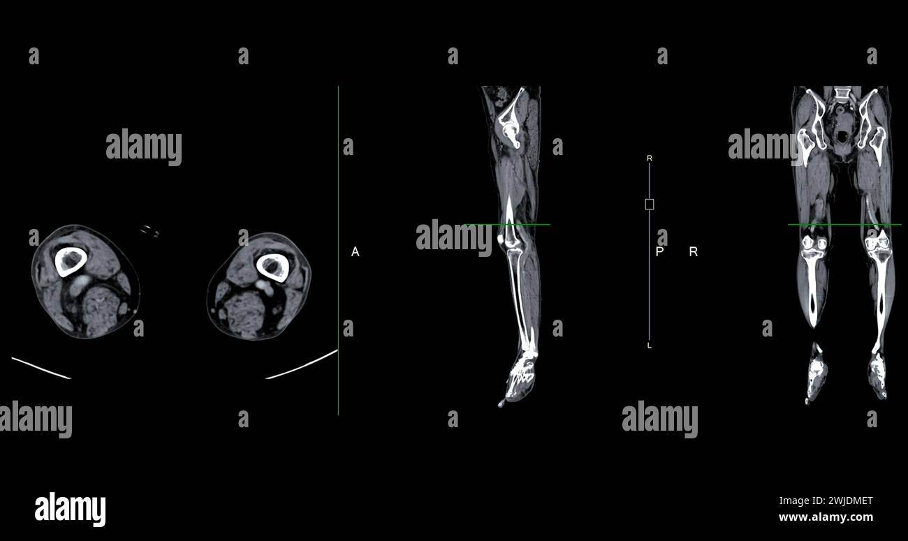 A CT venogram of the leg is a non-invasive imaging procedure offering ...