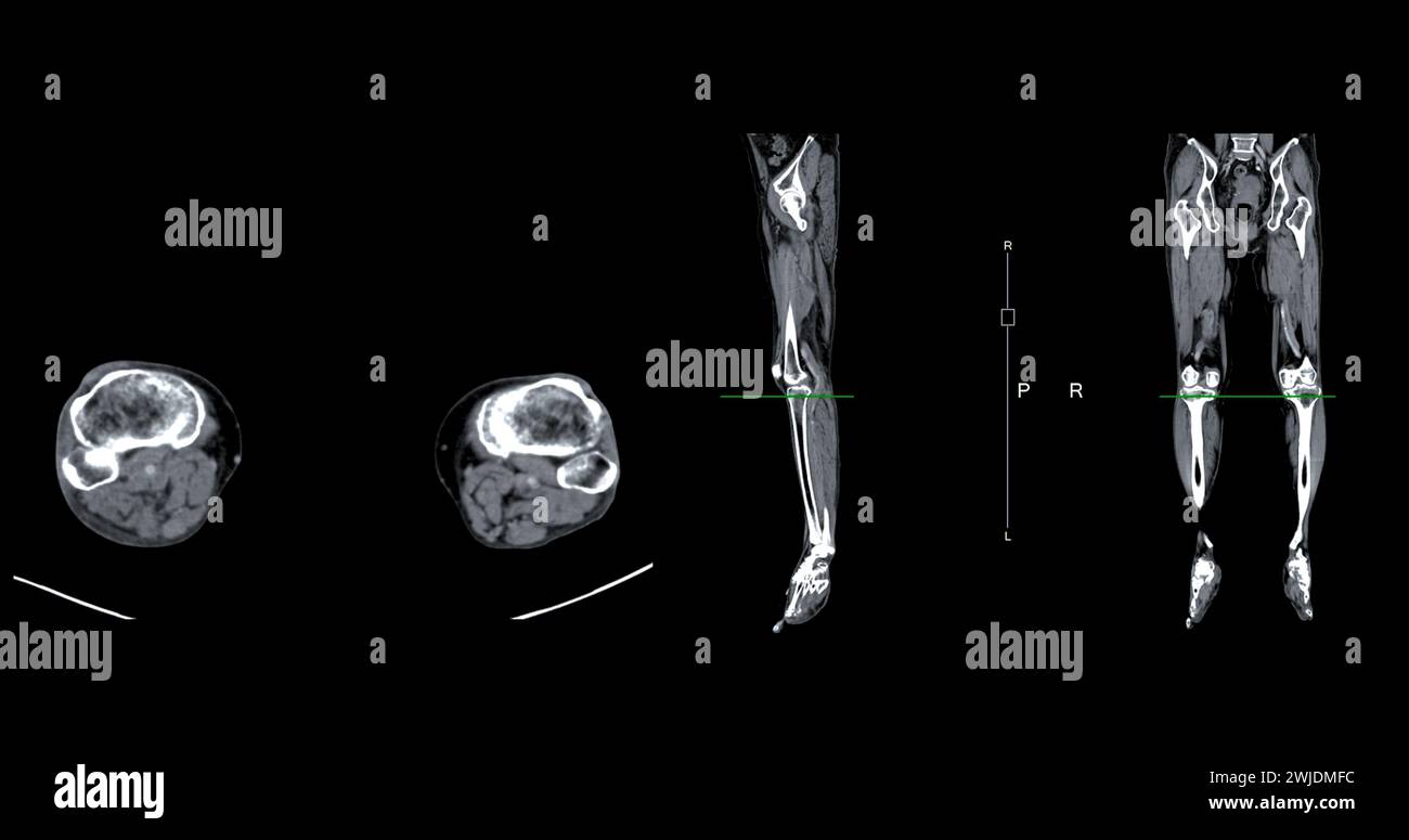 A CT venogram of the leg is a non-invasive imaging procedure offering ...