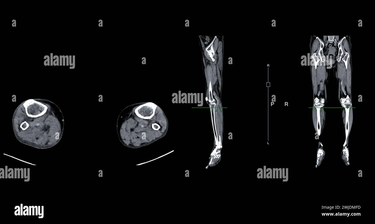 A CT venogram of the leg is a non-invasive imaging procedure offering ...