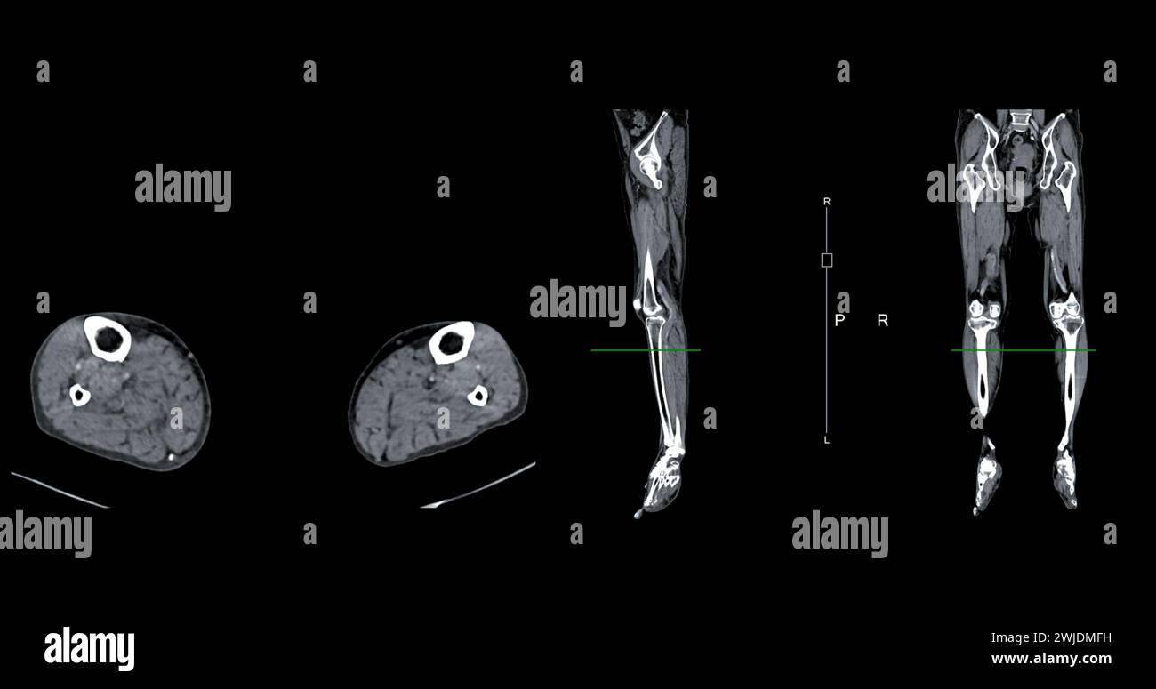 A CT venogram of the leg is a non-invasive imaging procedure offering ...