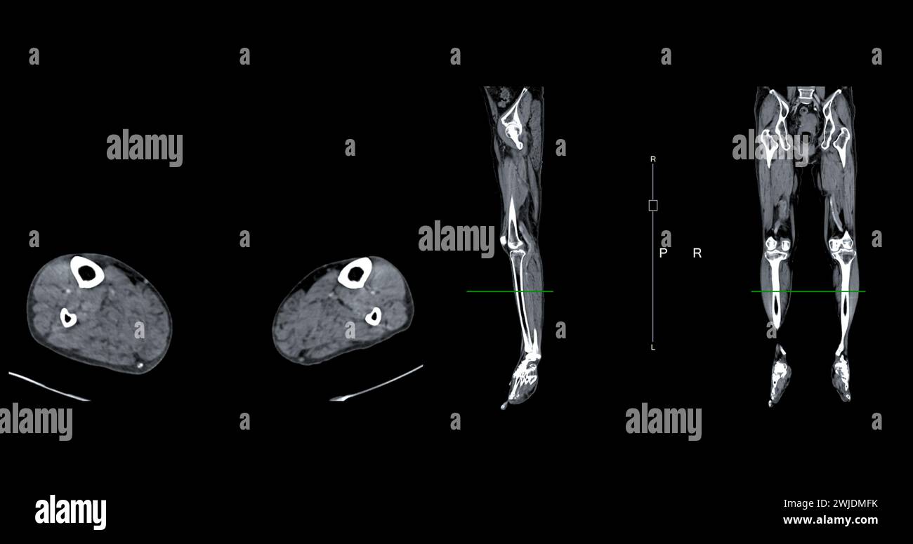A CT venogram of the leg is a non-invasive imaging procedure offering ...