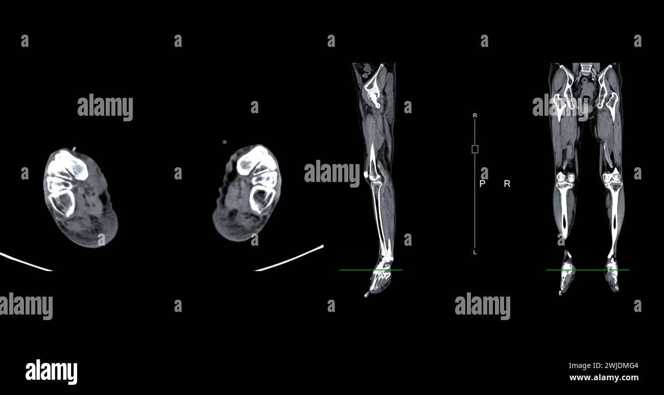 A CT venogram of the leg is a non-invasive imaging procedure offering ...