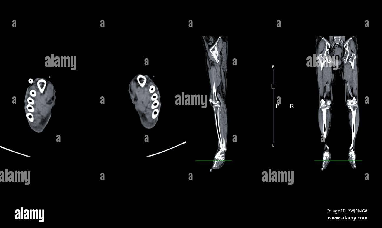 A CT venogram of the leg is a non-invasive imaging procedure offering ...