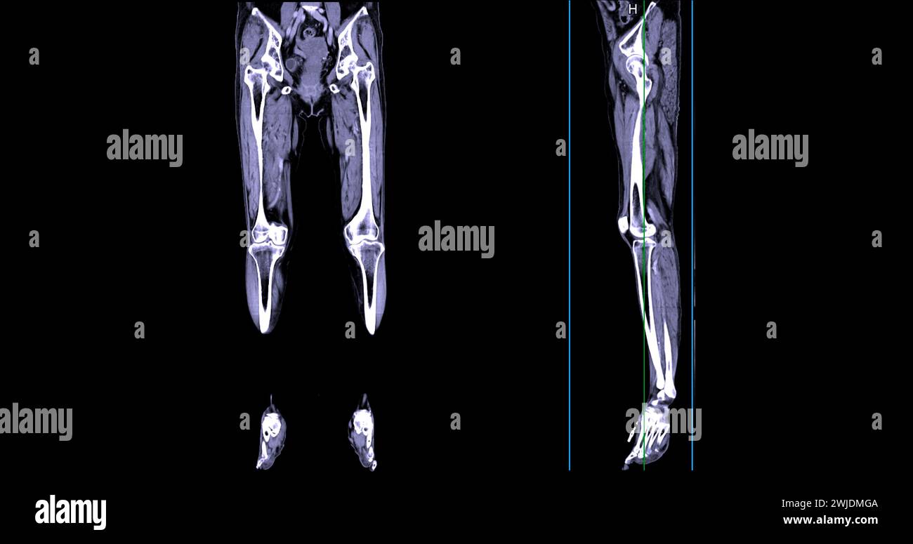 A CT venogram of the leg is a non-invasive imaging procedure offering ...