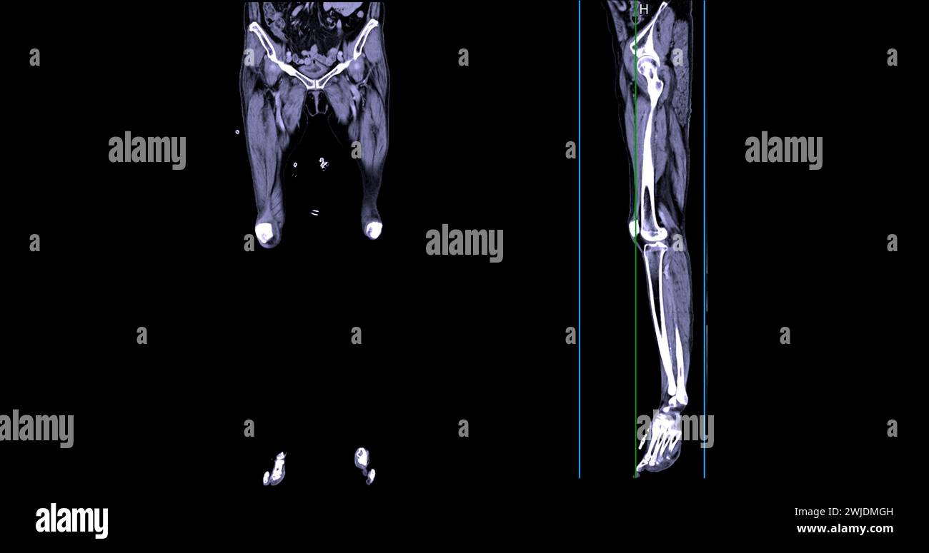 A CT venogram of the leg is a non-invasive imaging procedure offering ...