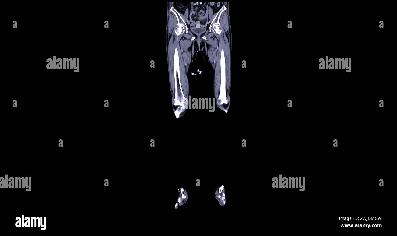 A CT venogram of the leg is a non-invasive imaging procedure offering ...
