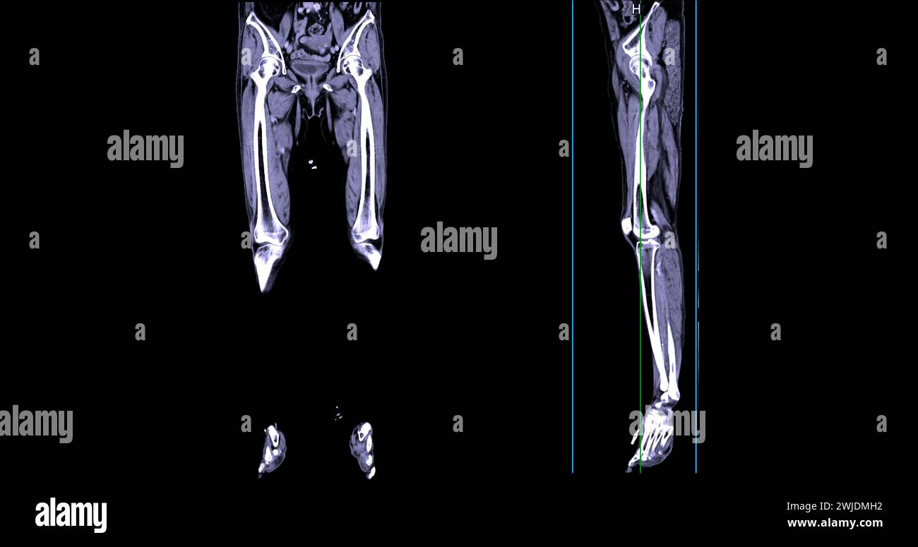 A CT venogram of the leg is a non-invasive imaging procedure offering ...