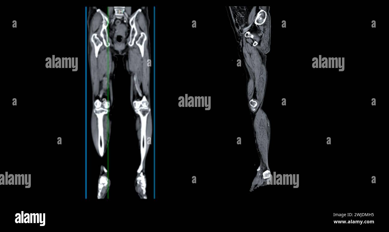 A CT venogram of the leg is a non-invasive imaging procedure offering ...