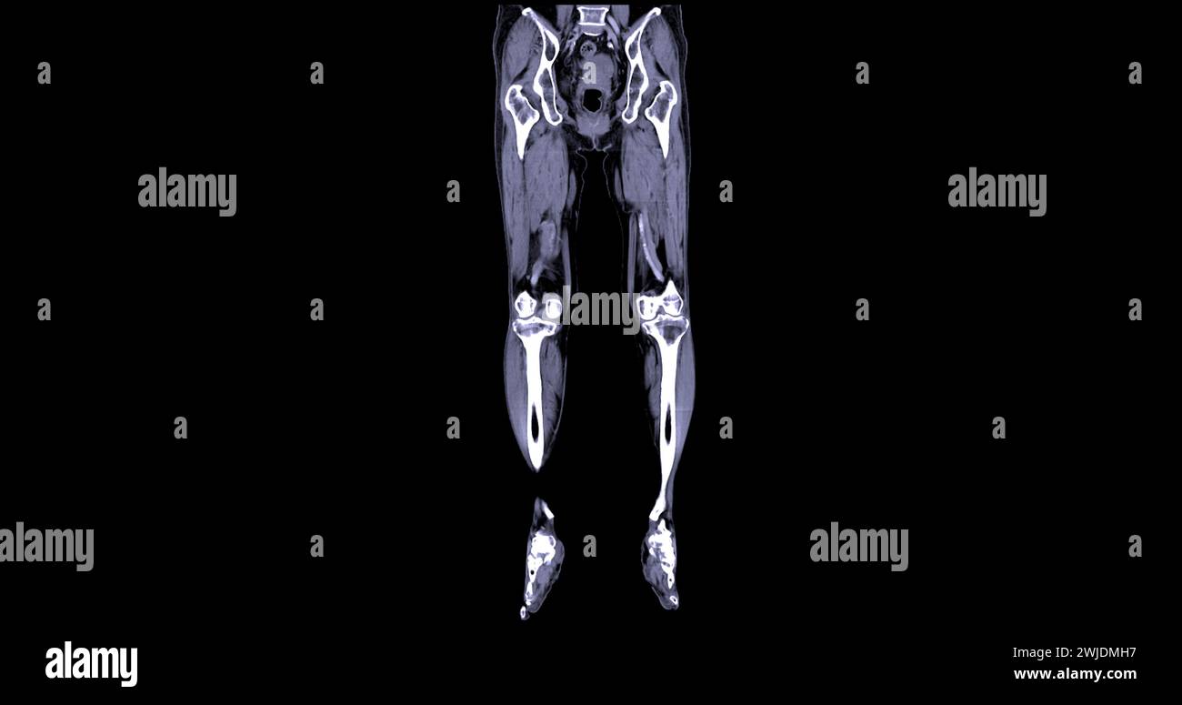 A CT venogram of the leg is a non-invasive imaging procedure offering ...