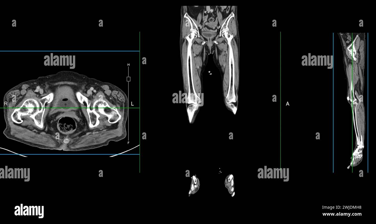 A CT venogram of the leg is a non-invasive imaging procedure offering ...