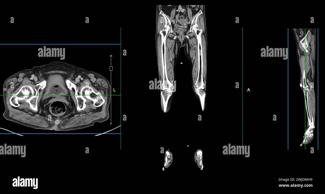 A CT venogram of the leg is a non-invasive imaging procedure offering ...
