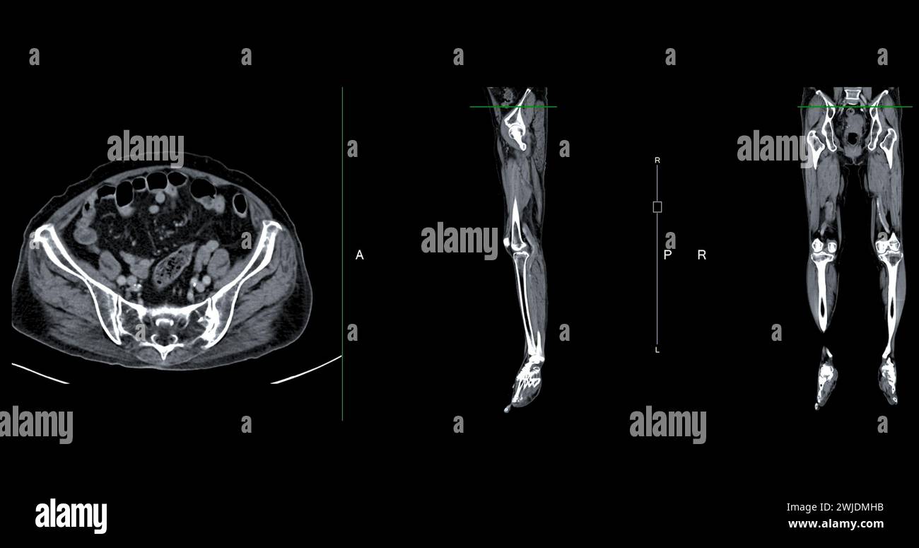 A CT venogram of the leg is a non-invasive imaging procedure offering ...