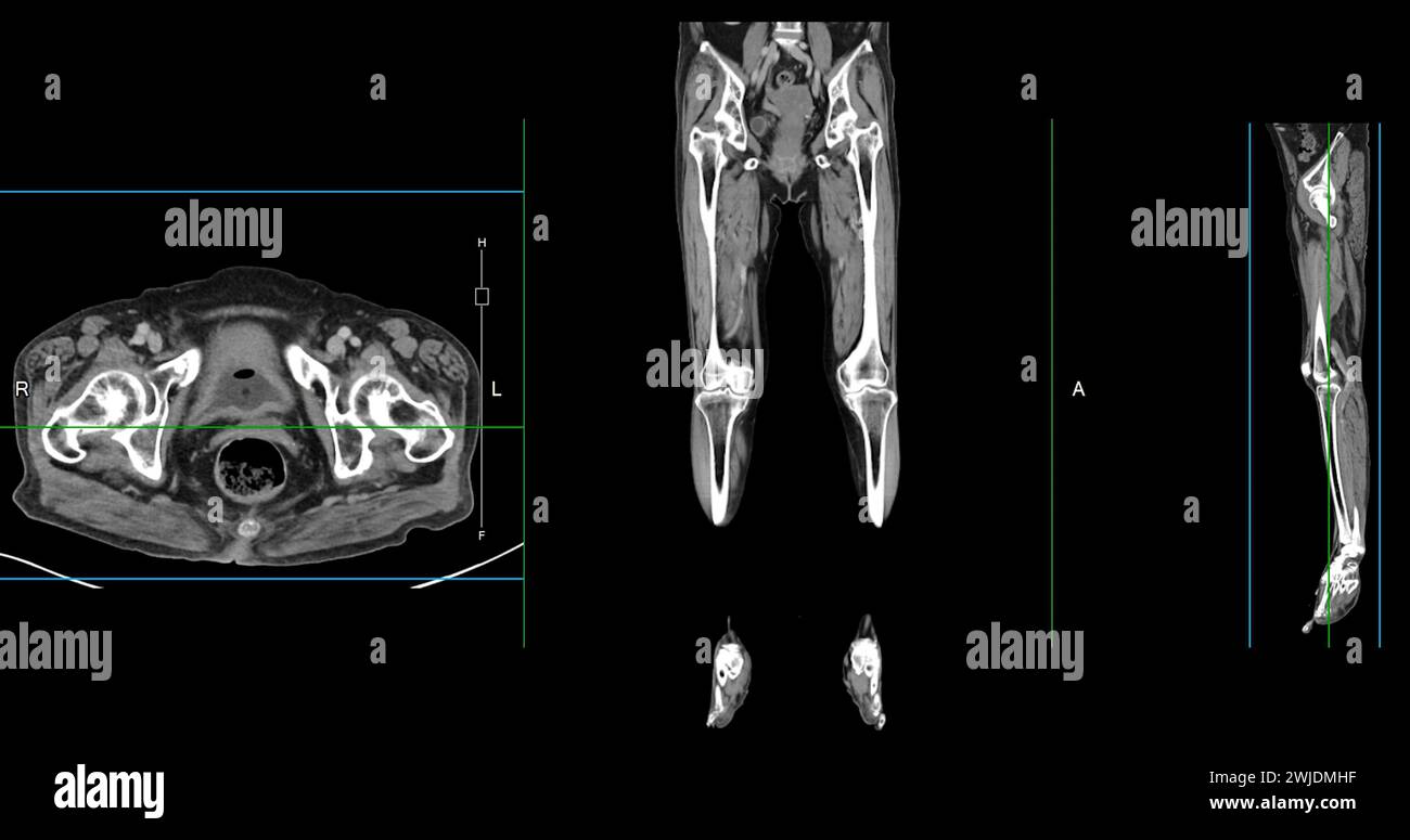 A CT venogram of the leg is a non-invasive imaging procedure offering ...