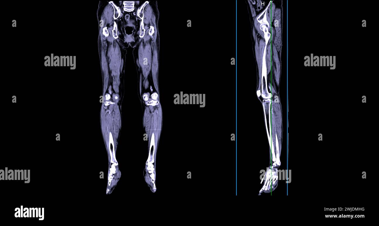 A CT venogram of the leg is a non-invasive imaging procedure offering ...