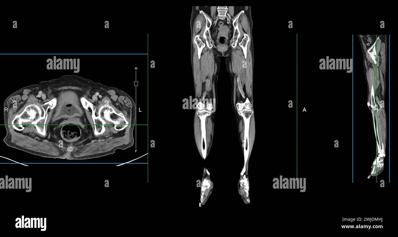 A CT venogram of the leg is a non-invasive imaging procedure offering ...