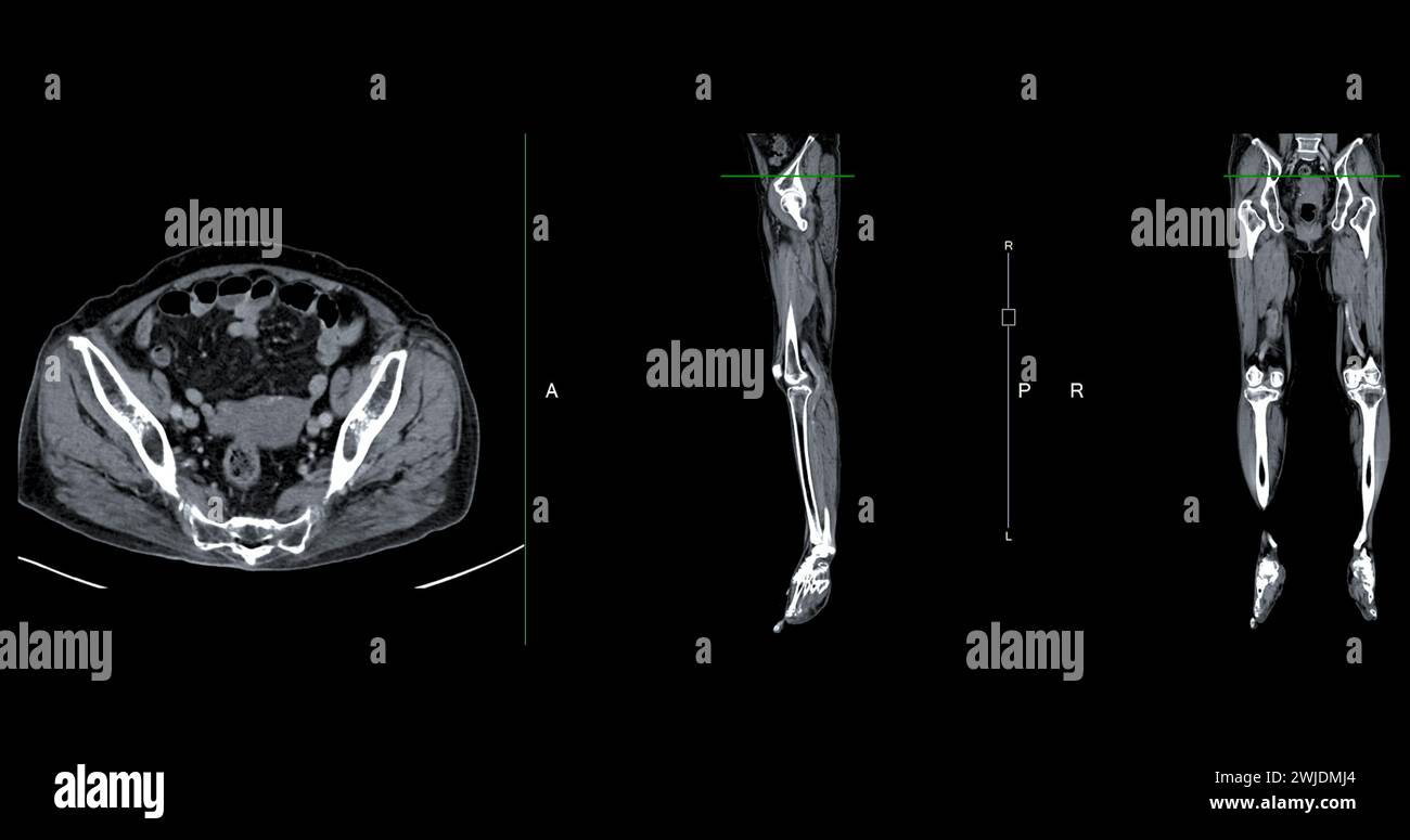 A CT venogram of the leg is a non-invasive imaging procedure offering ...