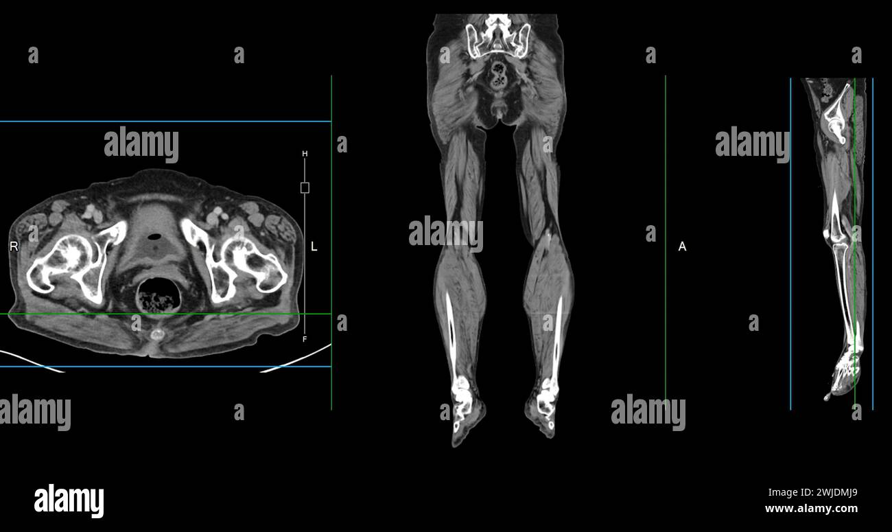 A CT venogram of the leg is a non-invasive imaging procedure offering ...