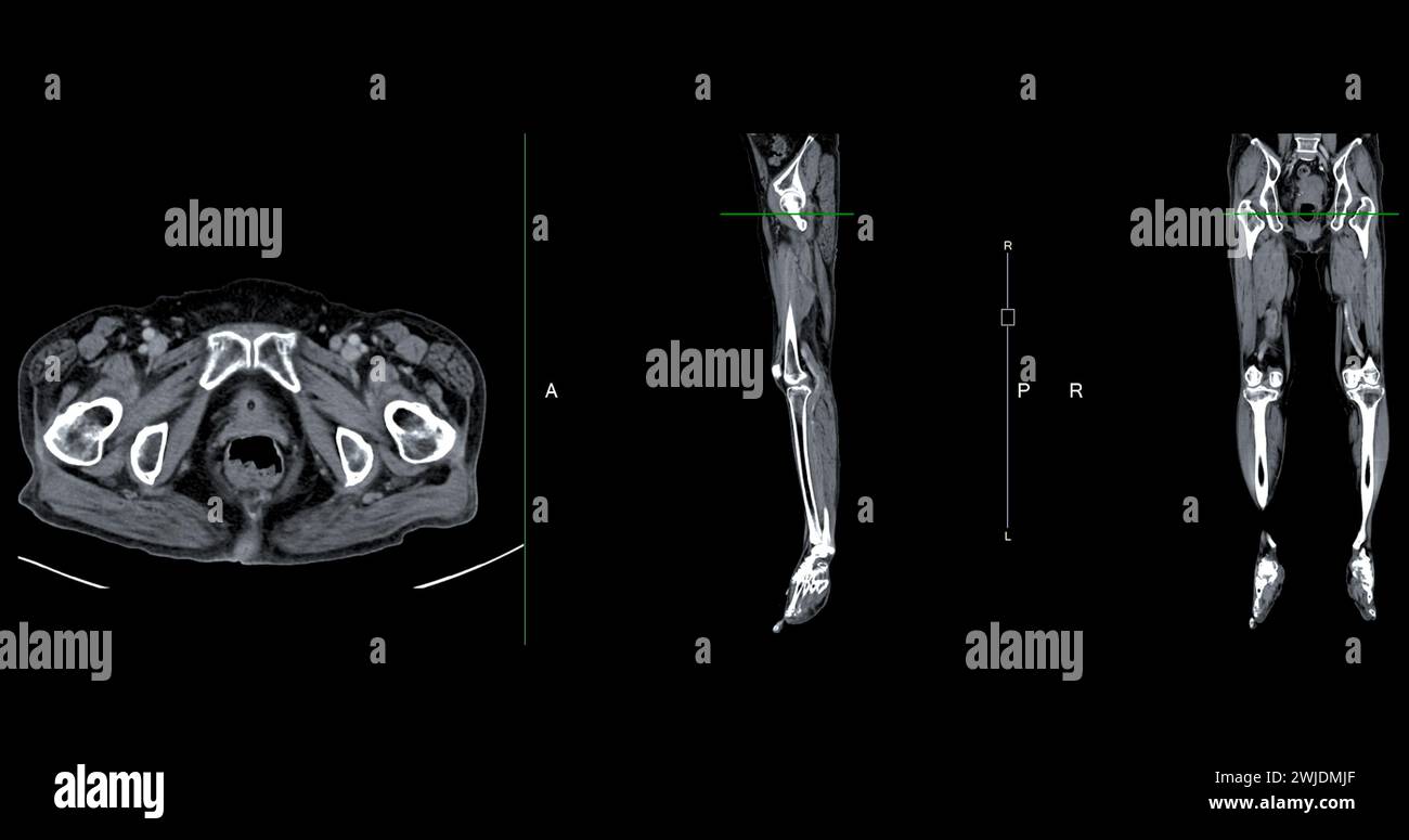 A CT venogram of the leg is a non-invasive imaging procedure offering ...