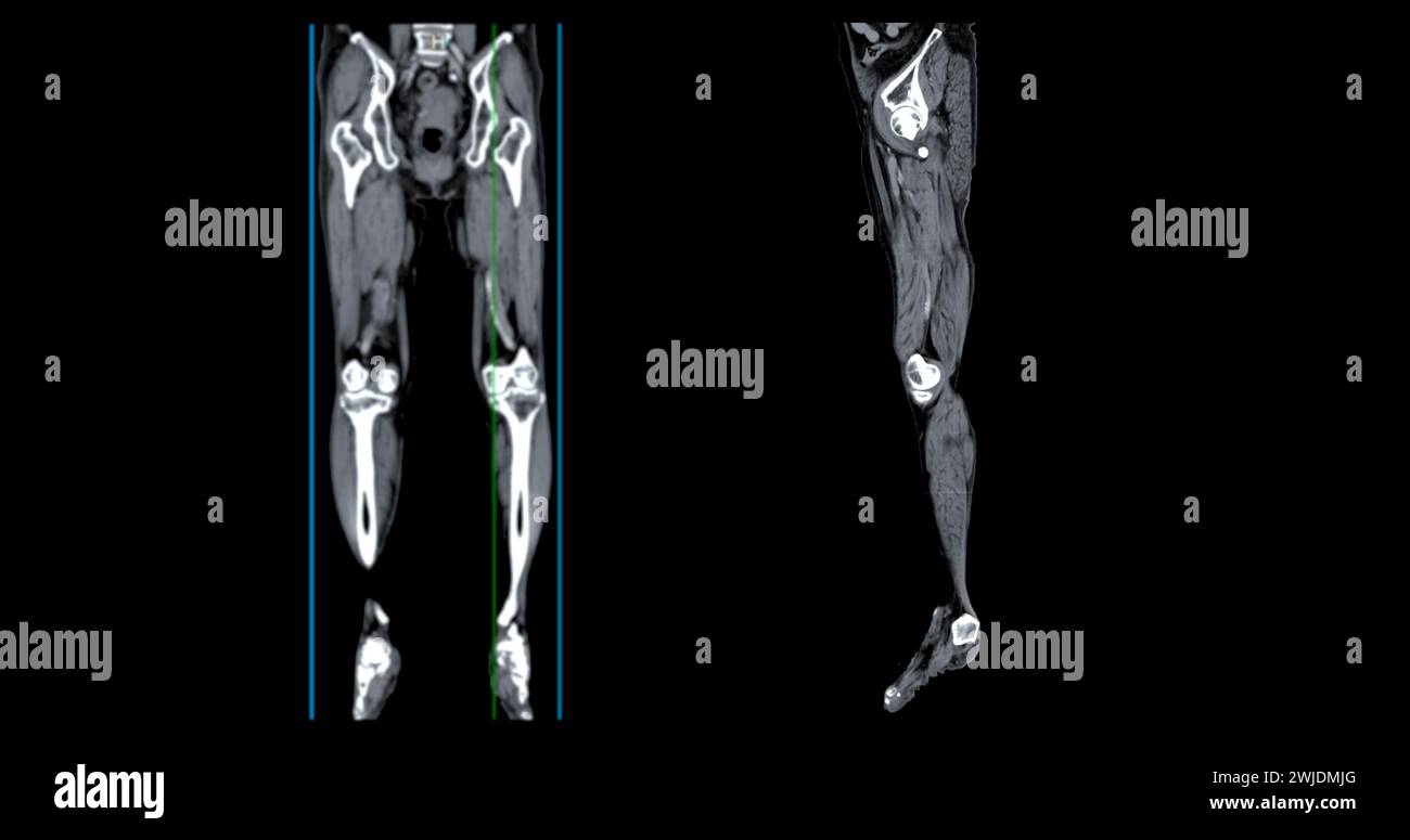A CT venogram of the leg is a non-invasive imaging procedure offering ...