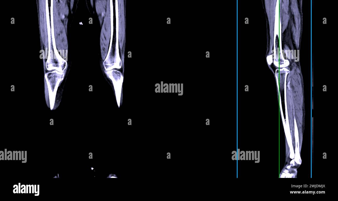 A CT venogram of the leg is a non-invasive imaging procedure offering ...