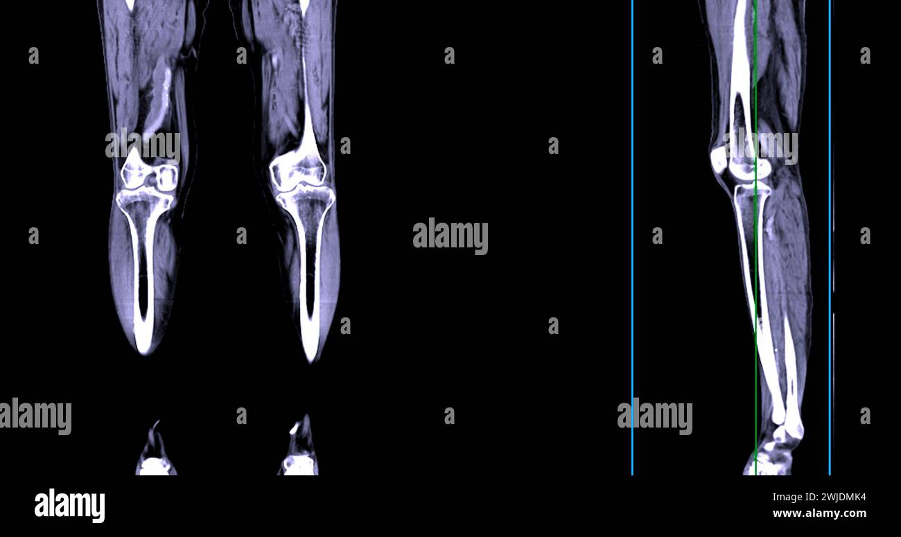 A CT venogram of the leg is a non-invasive imaging procedure offering ...