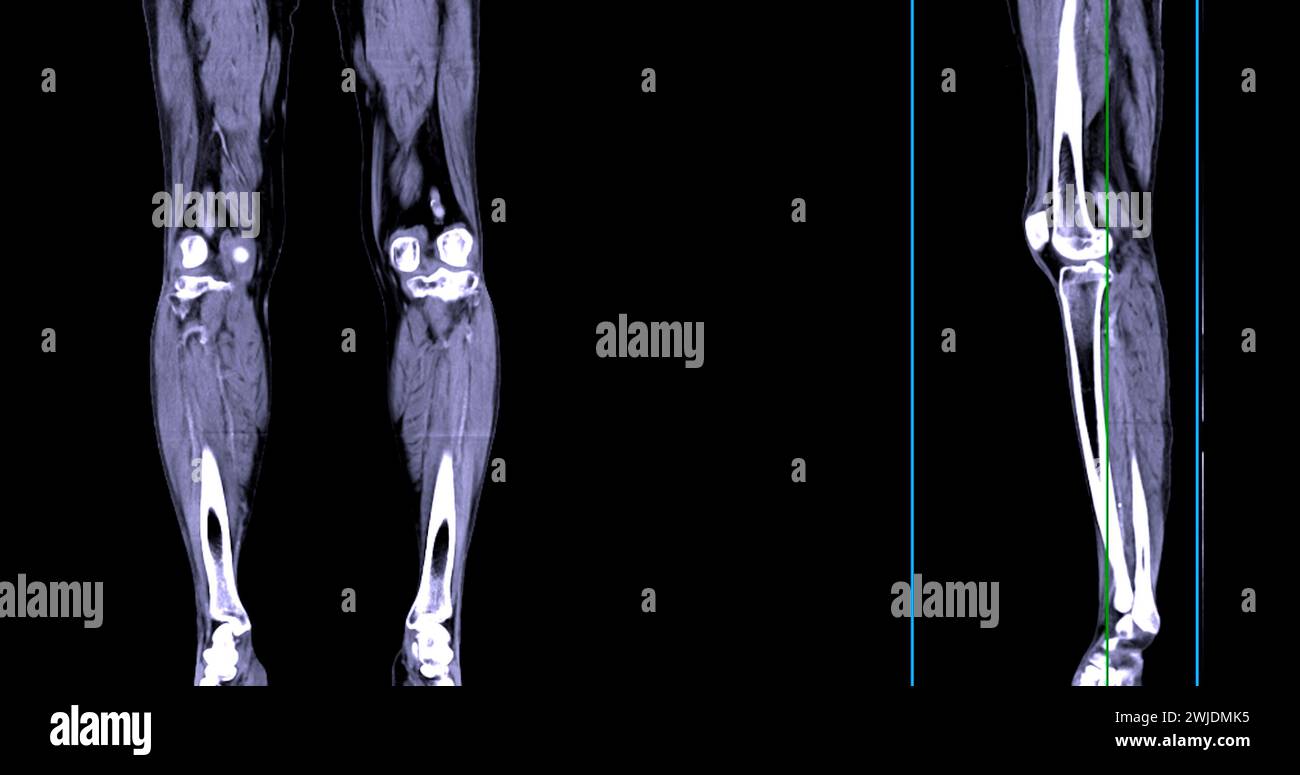 A CT venogram of the leg is a non-invasive imaging procedure offering ...