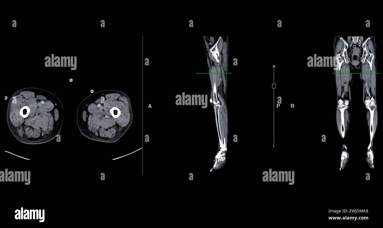 A CT venogram of the leg is a non-invasive imaging procedure offering ...