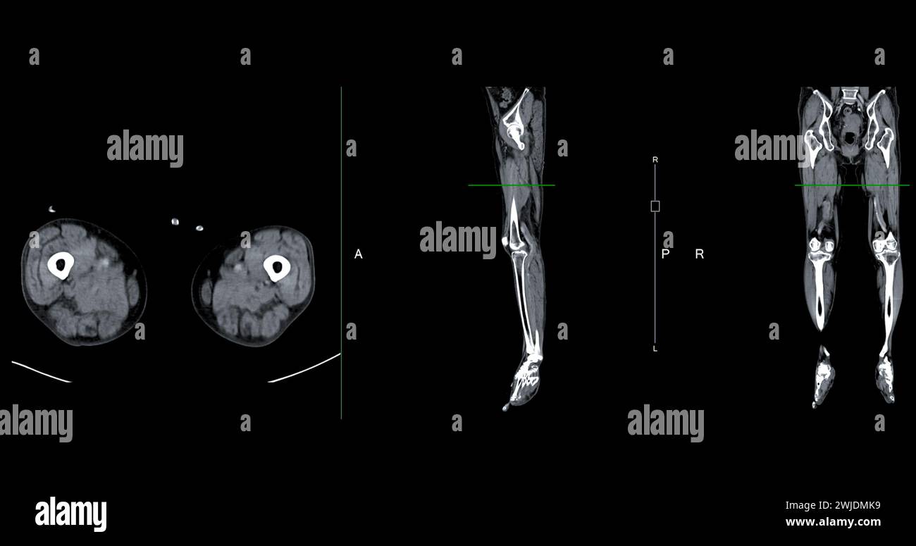 A CT venogram of the leg is a non-invasive imaging procedure offering ...
