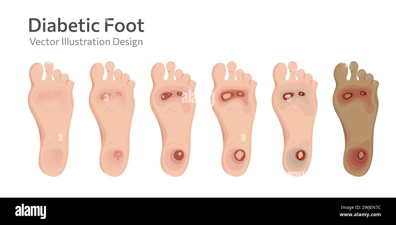 Diabetic foot different stages vector illustration Stock Vector Image ...