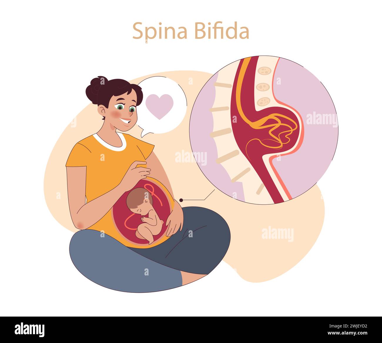 Spina Bifida concept. Expectant mother visualizes her baby's condition ...