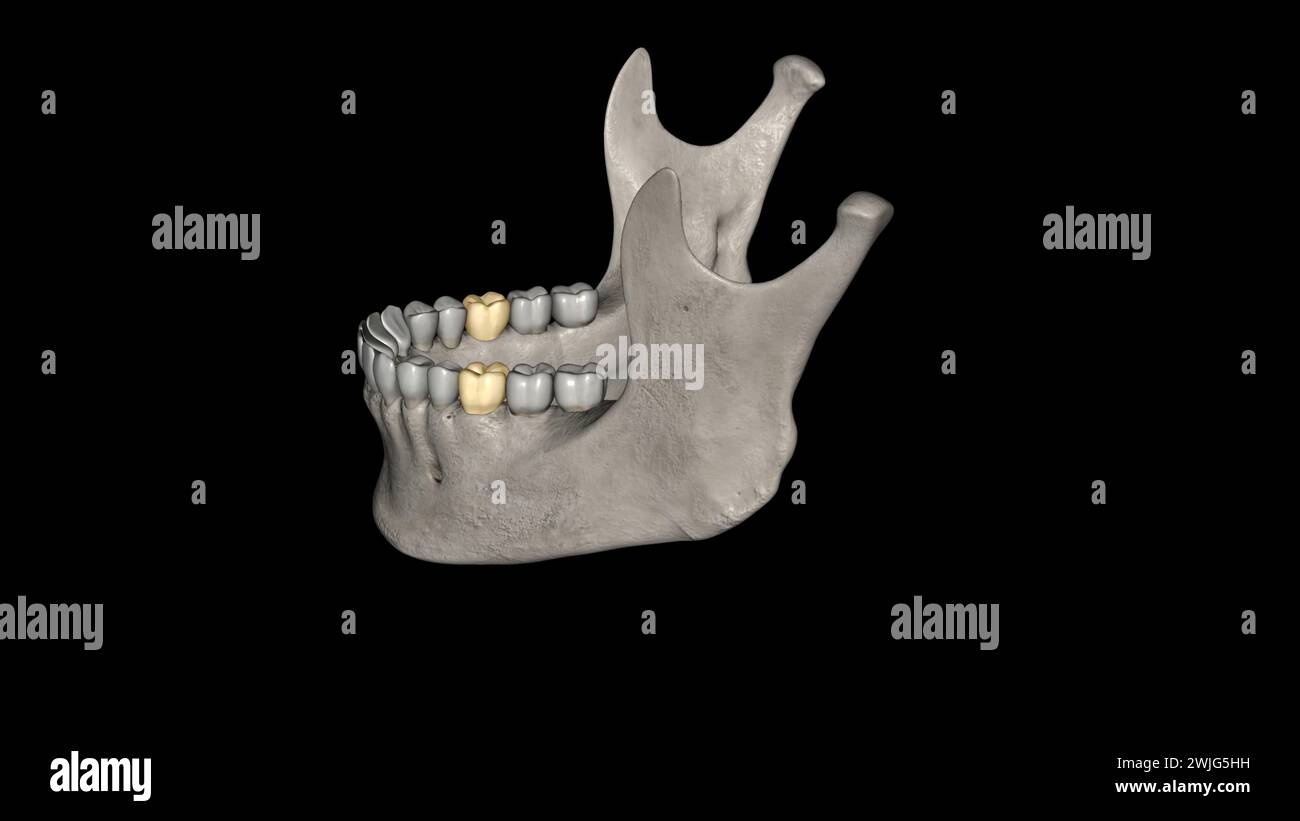The mandibular first molar usually has two roots, a mesial and a distal ...