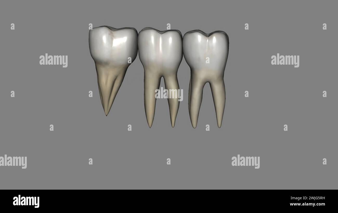 The mandibular first molar usually has two roots, a mesial and a distal ...