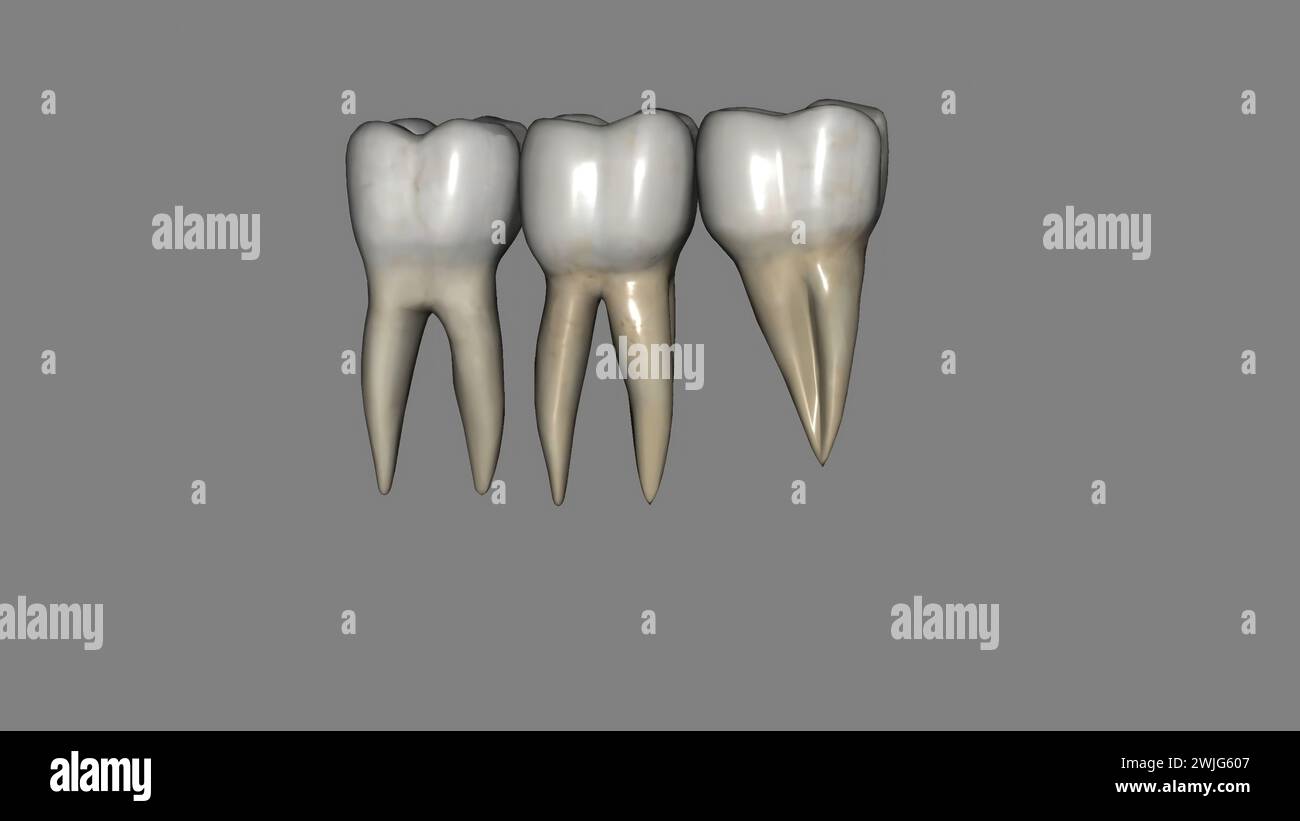 The mandibular first molar usually has two roots, a mesial and a distal ...