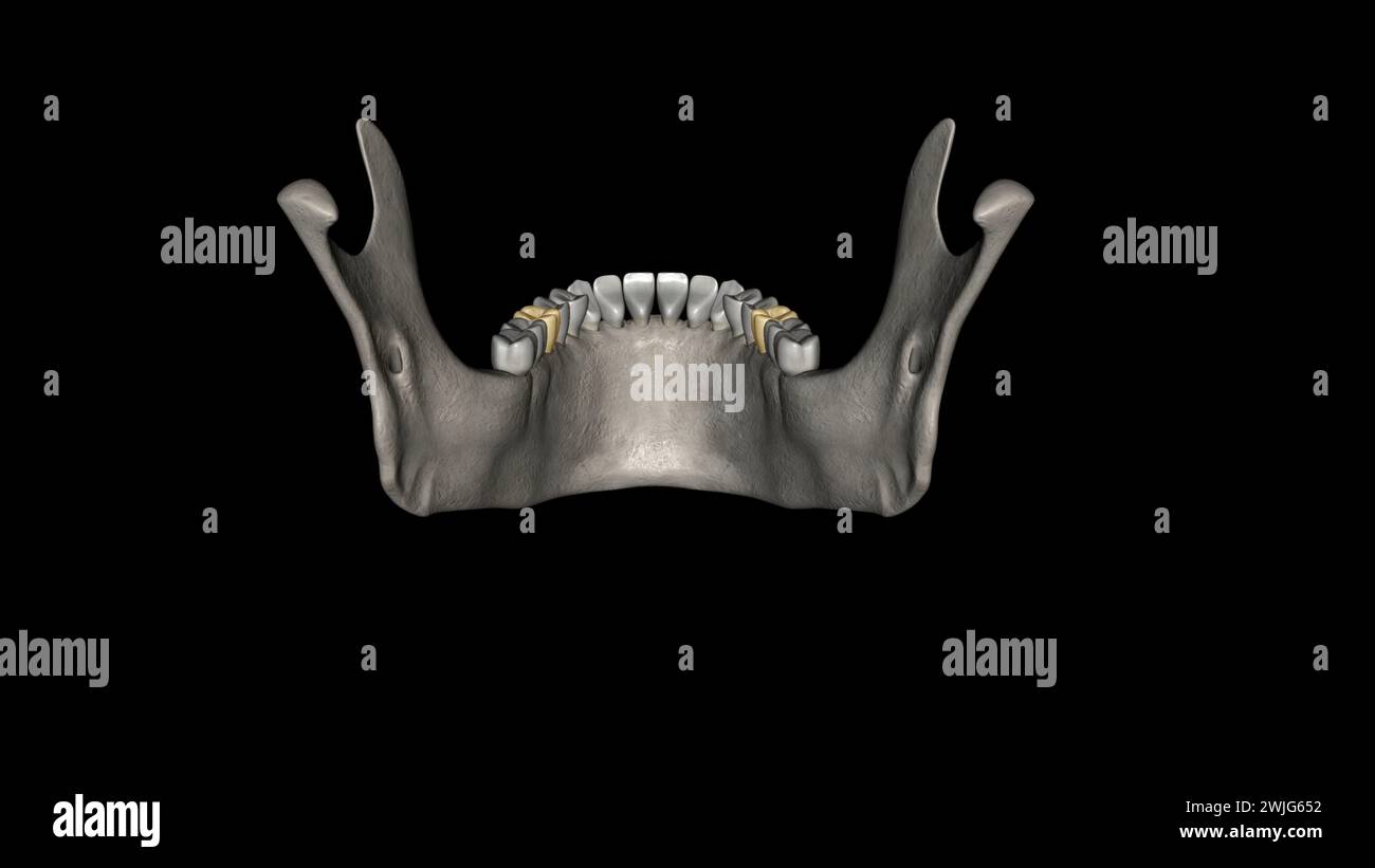 The mandibular first molar usually has two roots, a mesial and a distal ...