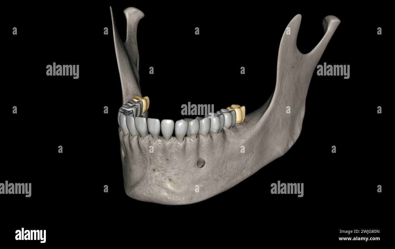 The mandibular third molar is also referred as the wisdom tooth 3d ...