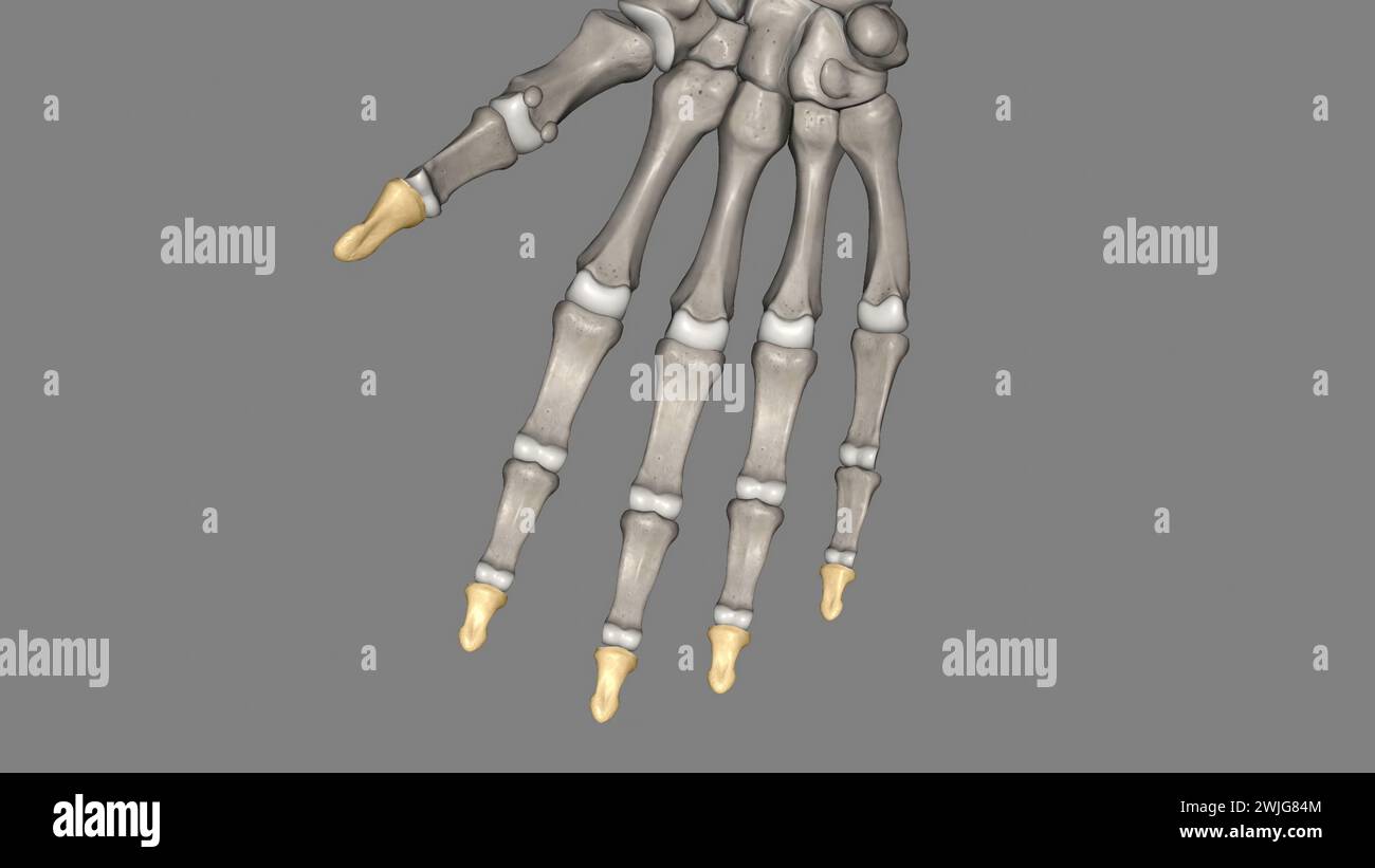 Distal femur fracture hi-res stock photography and images - Alamy