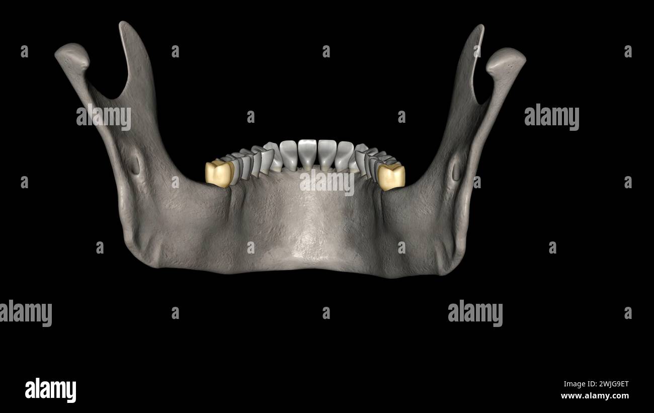 The mandibular third molar is also referred as the wisdom tooth 3d ...