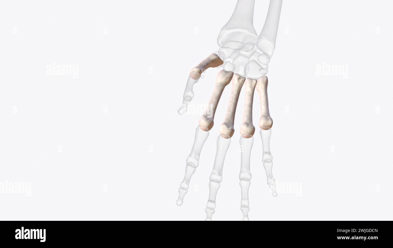 Metacarpal fracture Cut Out Stock Images & Pictures - Alamy