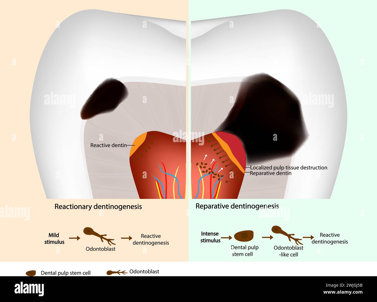 Tertiary dentin formation. Reparative dentinogenesis and Reactive ...