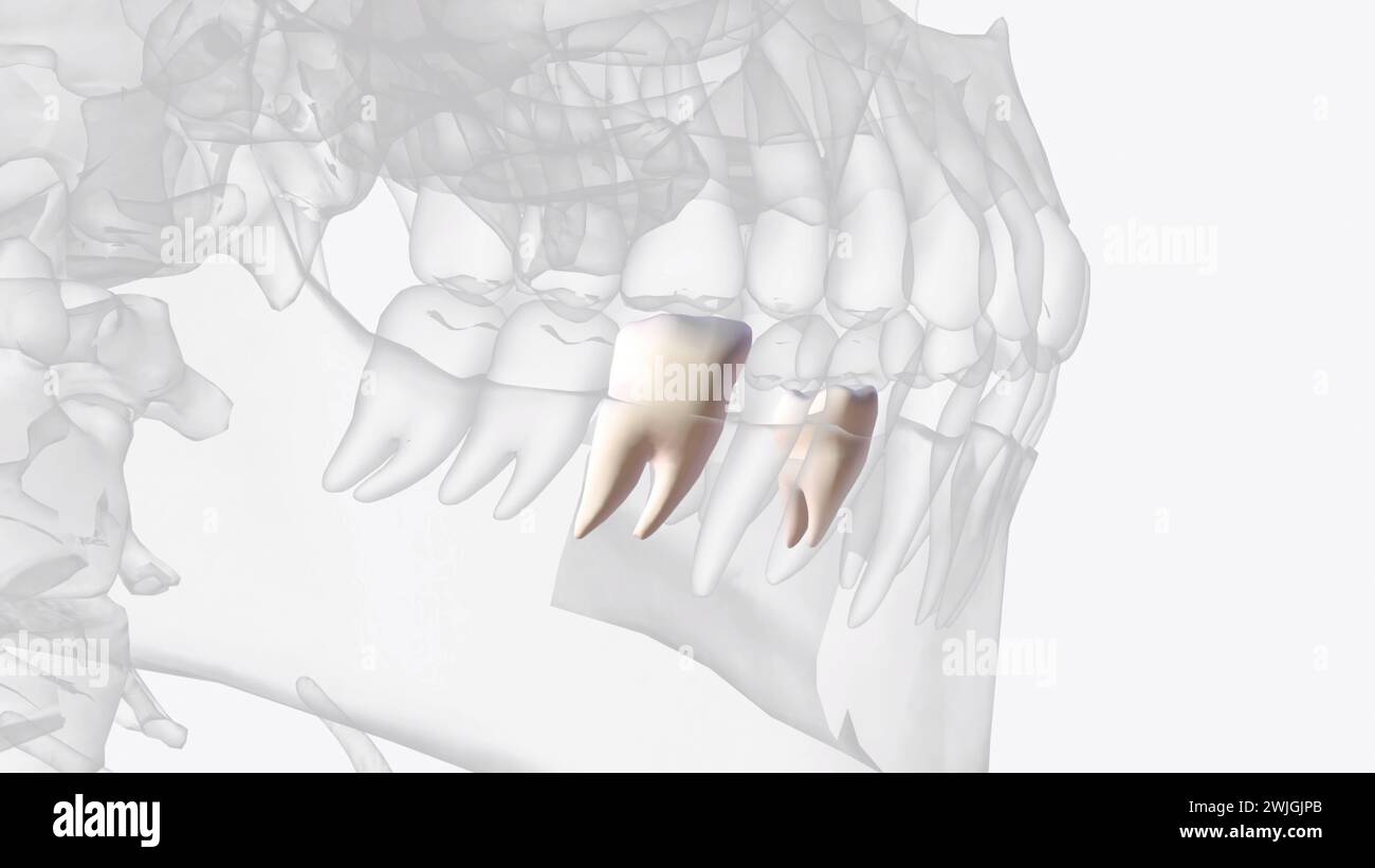 The mandibular first molar usually has two roots, a mesial and a distal ...