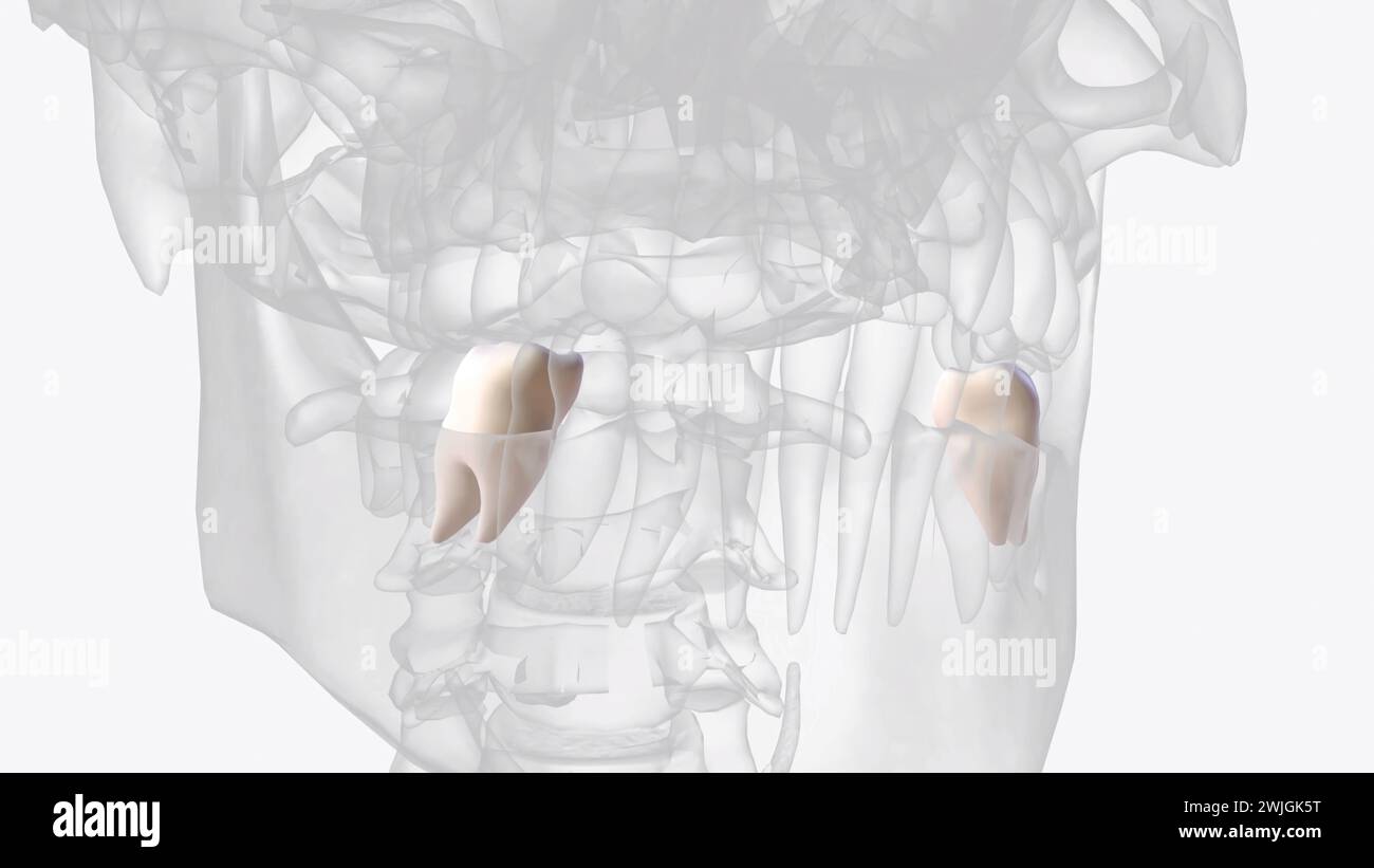 The mandibular first molar usually has two roots, a mesial and a distal ...