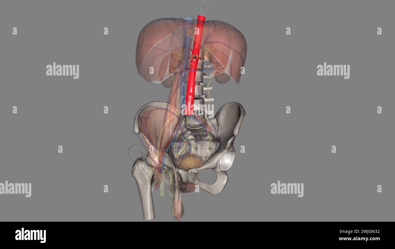 An abdominal aortic aneurysm is an enlarged area in the lower part of ...