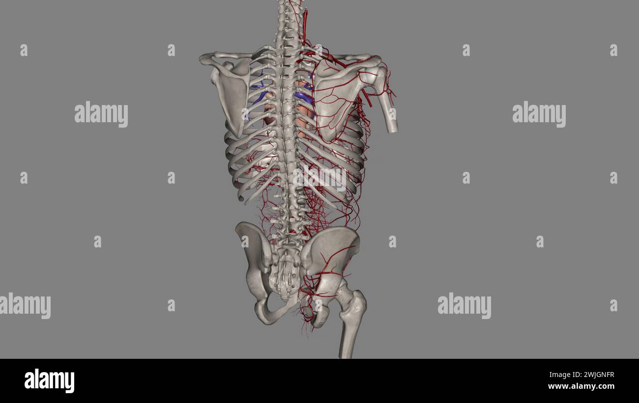 Common arterial trunk is a defect in which a single great artery 3d ...