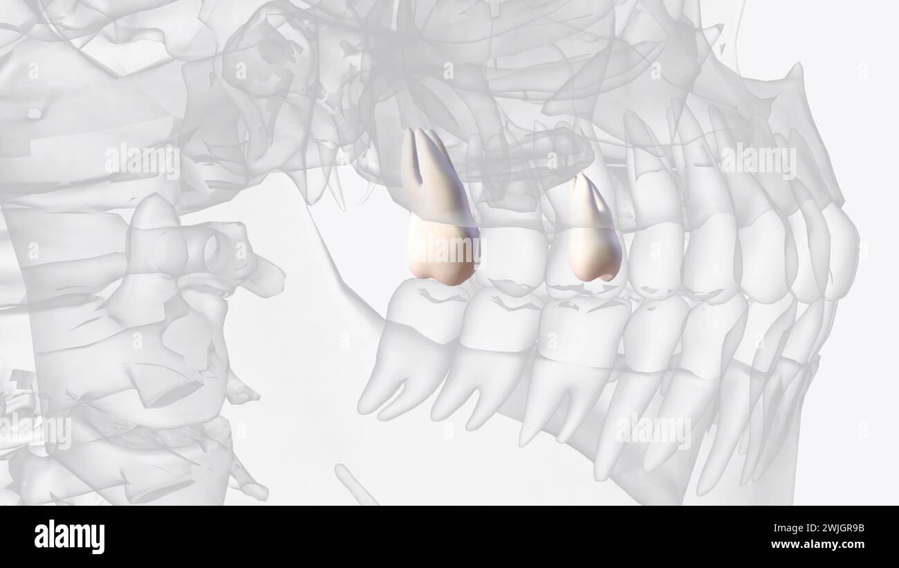 The maxillary third molar is the most distal tooth in the arch and ...
