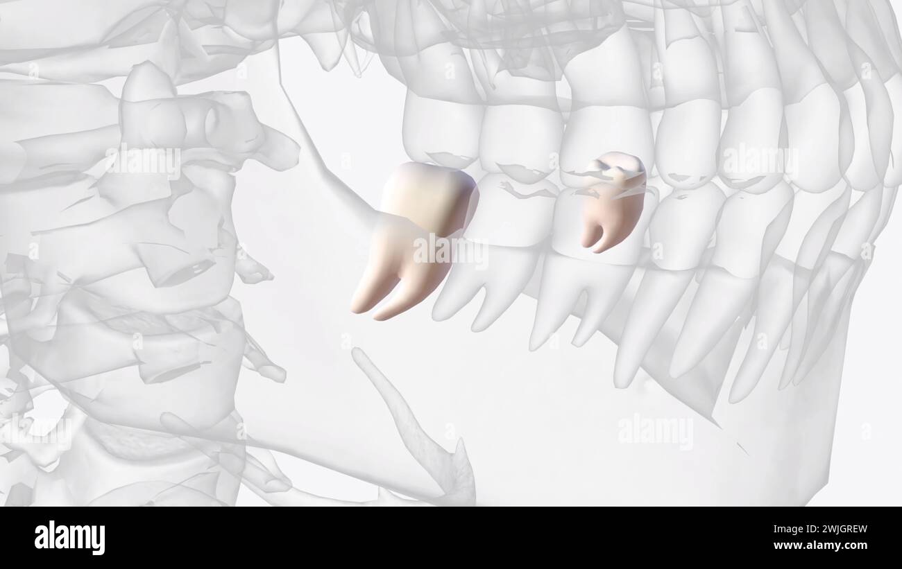 Mandibular third molars usually have two roots: mesial and distal as on ...