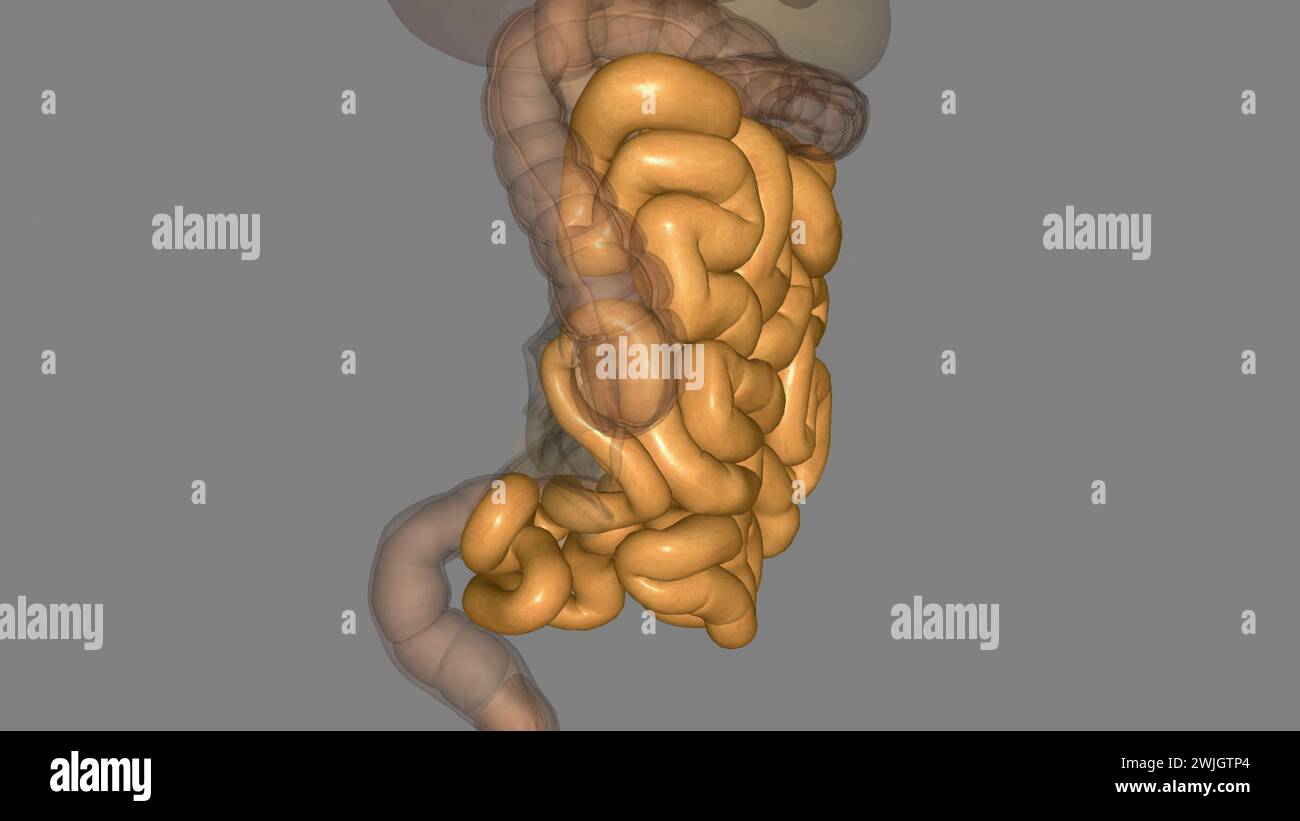 Small intestine tumor illustration hi-res stock photography and images ...