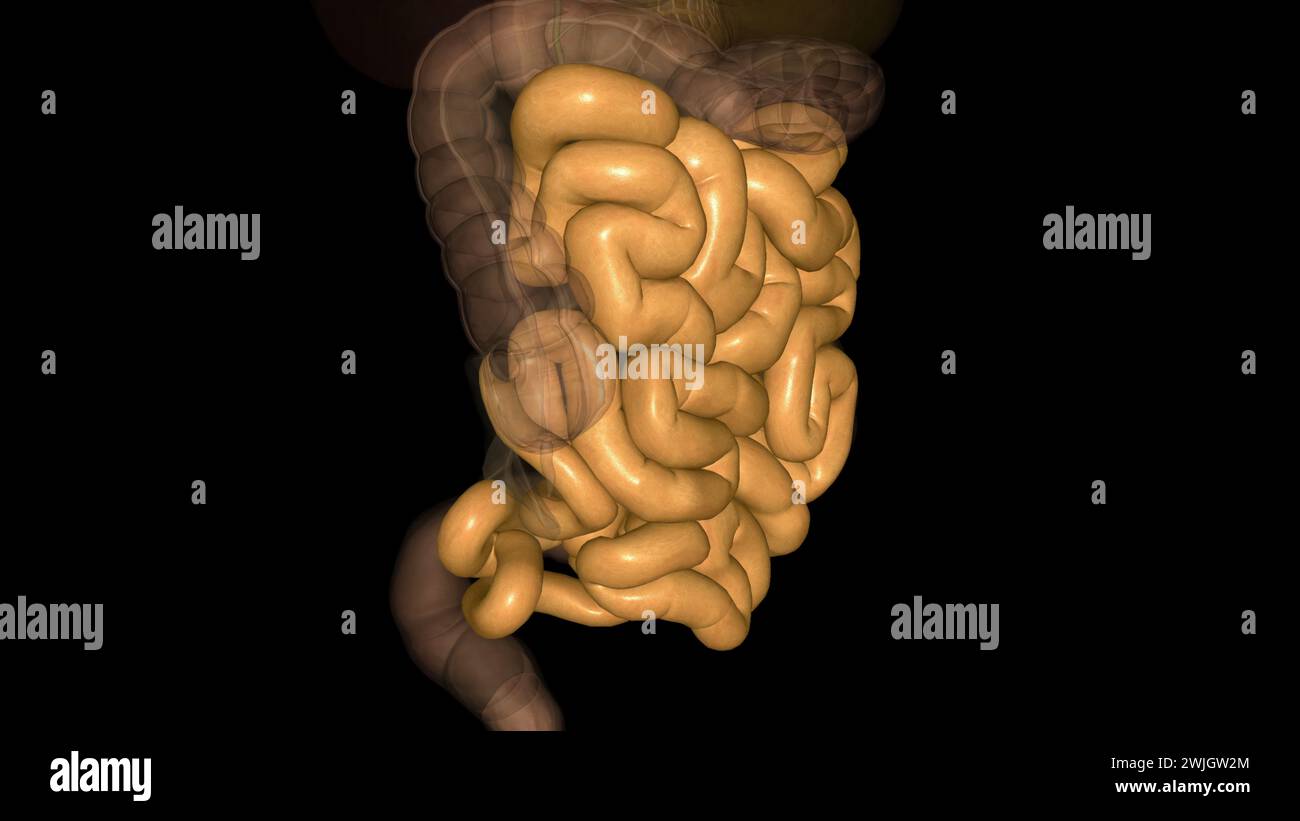 Small intestine tumor illustration hi-res stock photography and images ...