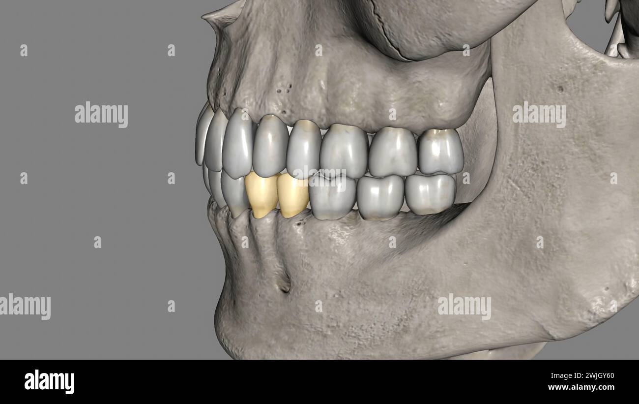 The mandibular first premolar is the tooth located laterally from both ...
