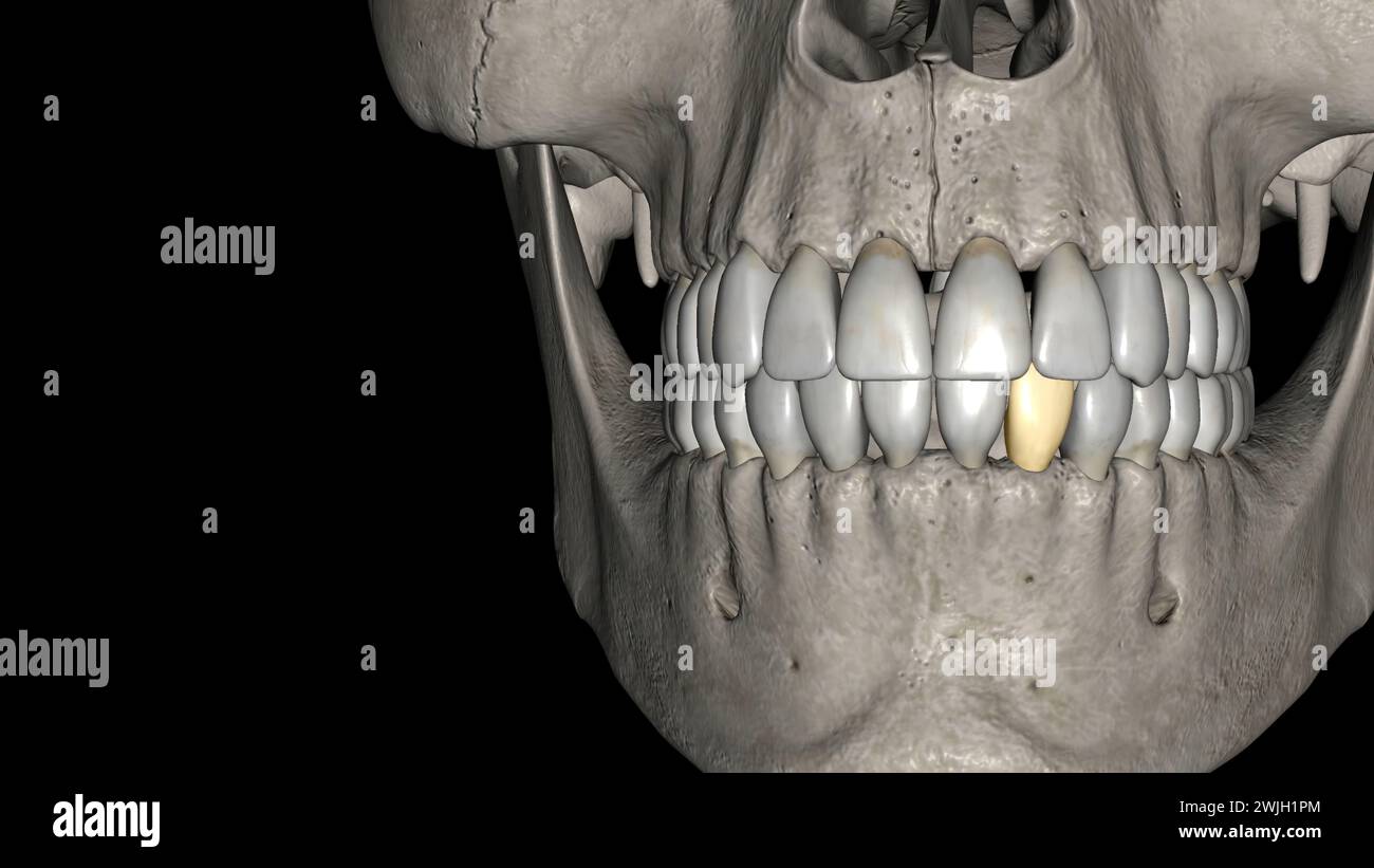 The mandibular lateral incisor is the tooth located distally from both ...